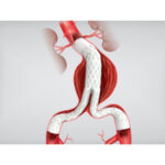 Aortic Intervention